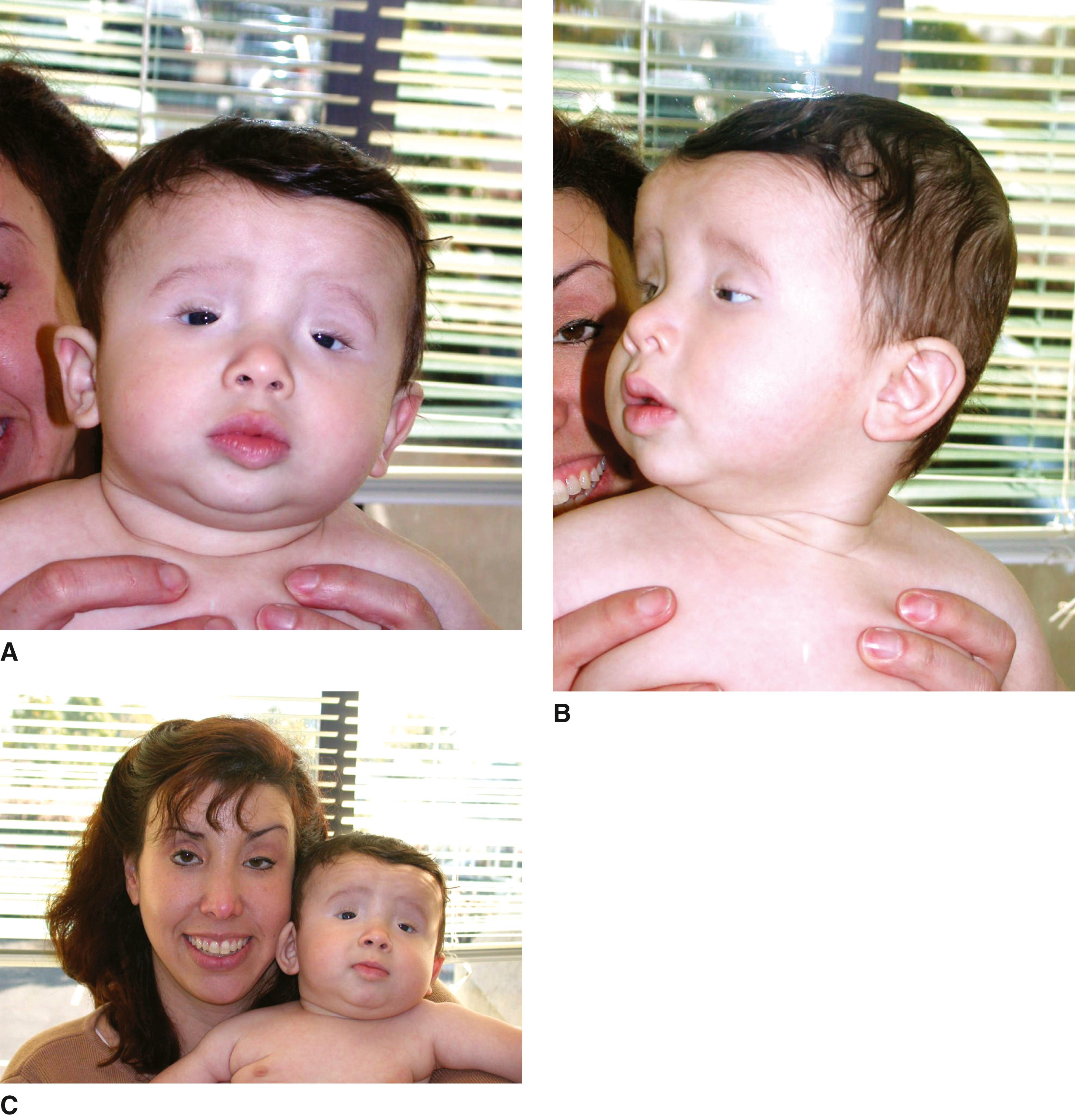 Facial Defects as Major Feature - Clinical Tree