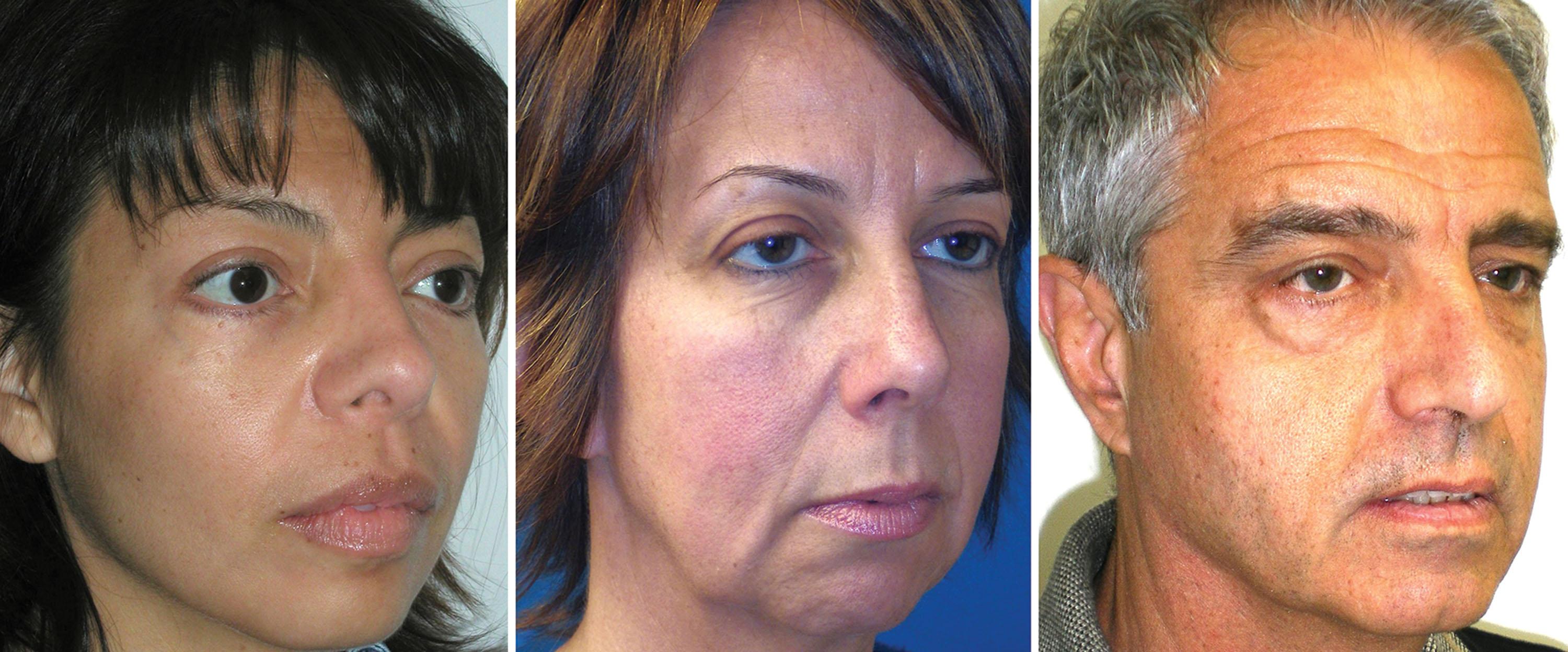 Facial Implants - Clinical Tree