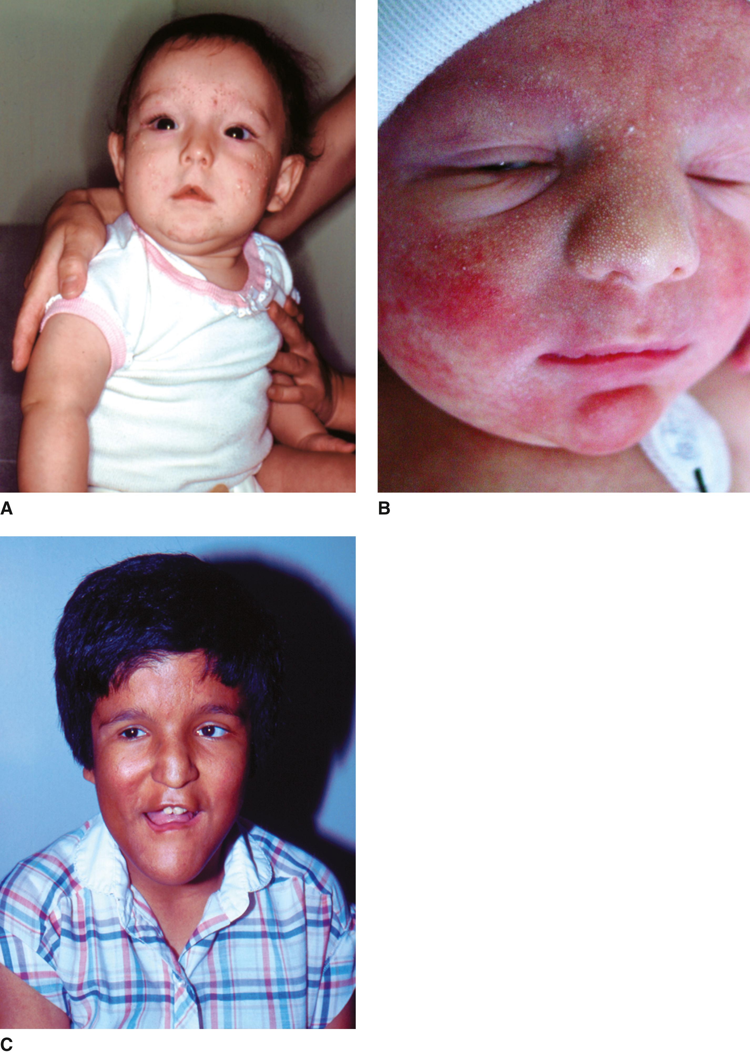 Facial-Limb Defects as Major Feature - Clinical Tree