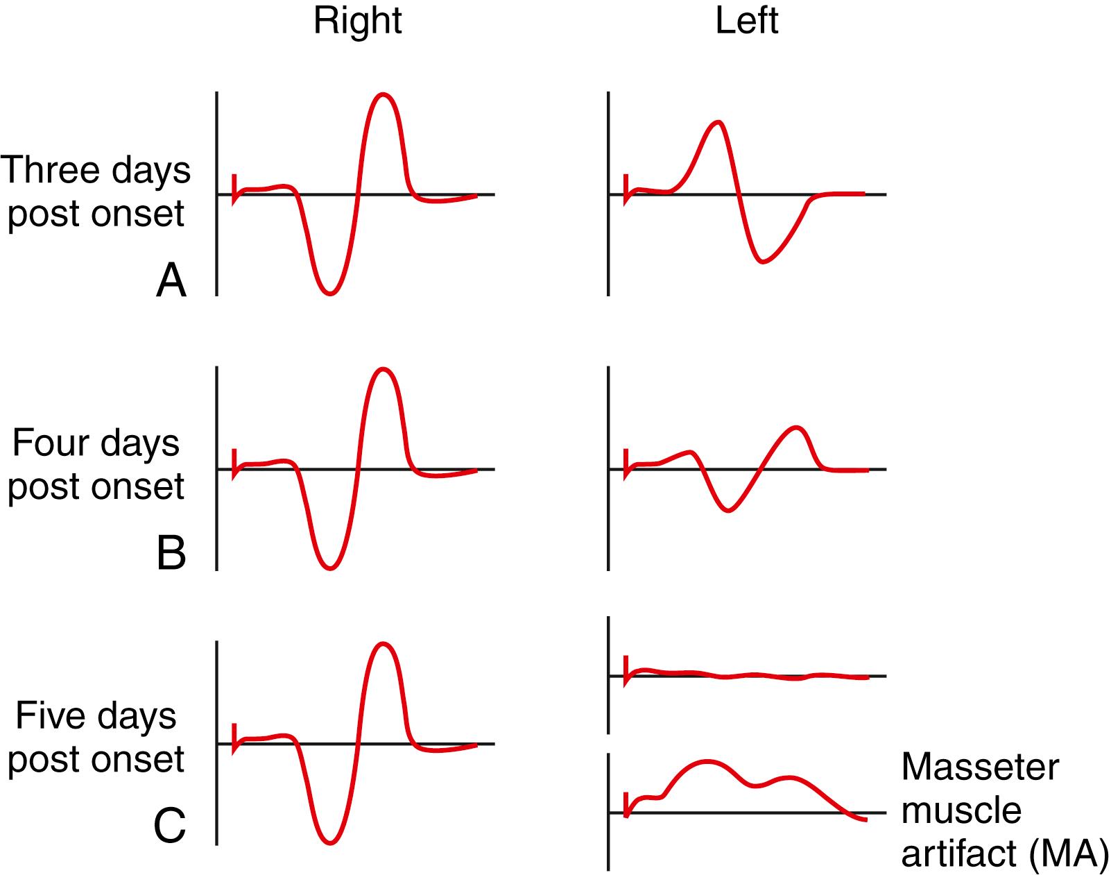Facial Nerve Decompression - Clinical Tree