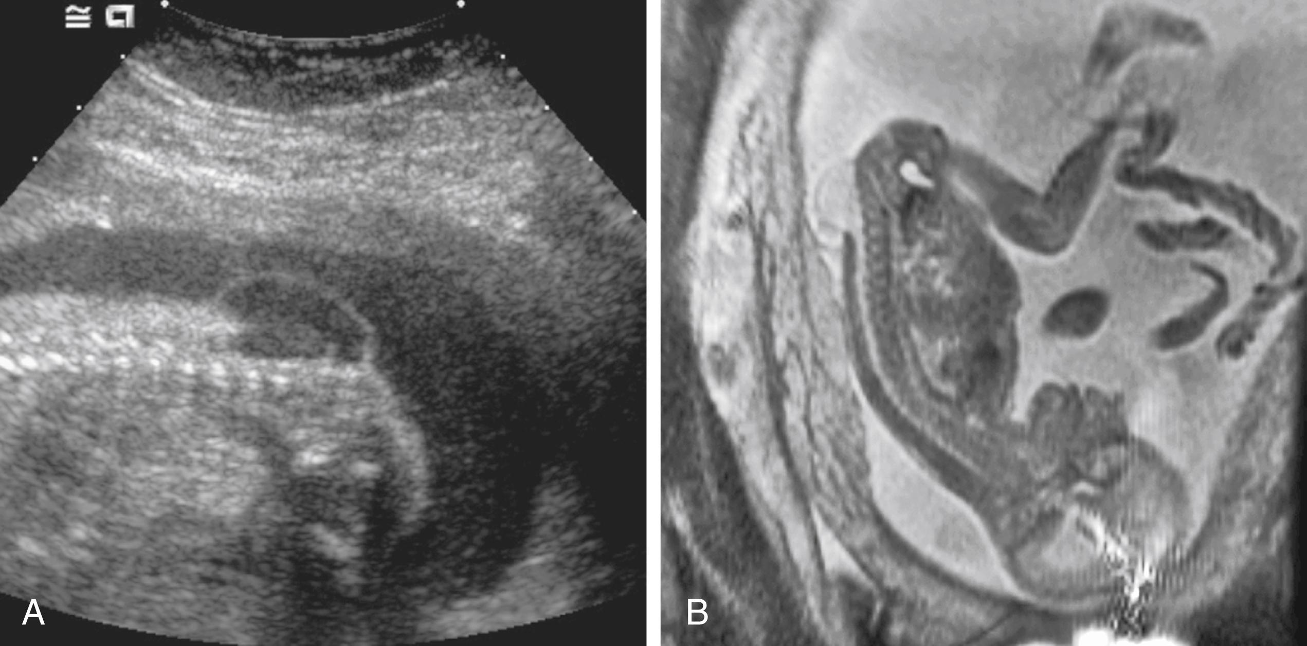 Fetal Surgery for Open Neural Tube Defects - Clinical Tree
