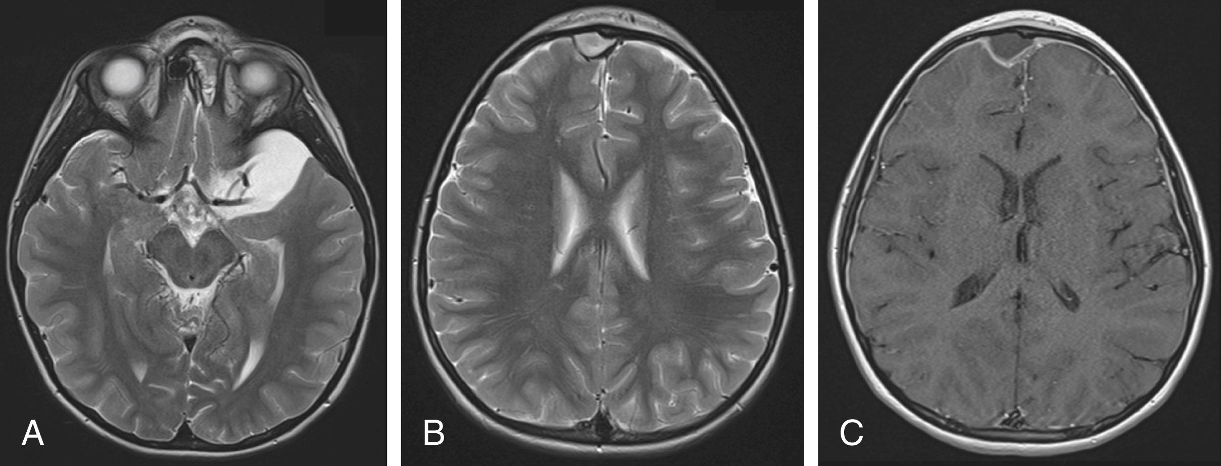 Fever And Forehead Swelling - Clinical Tree