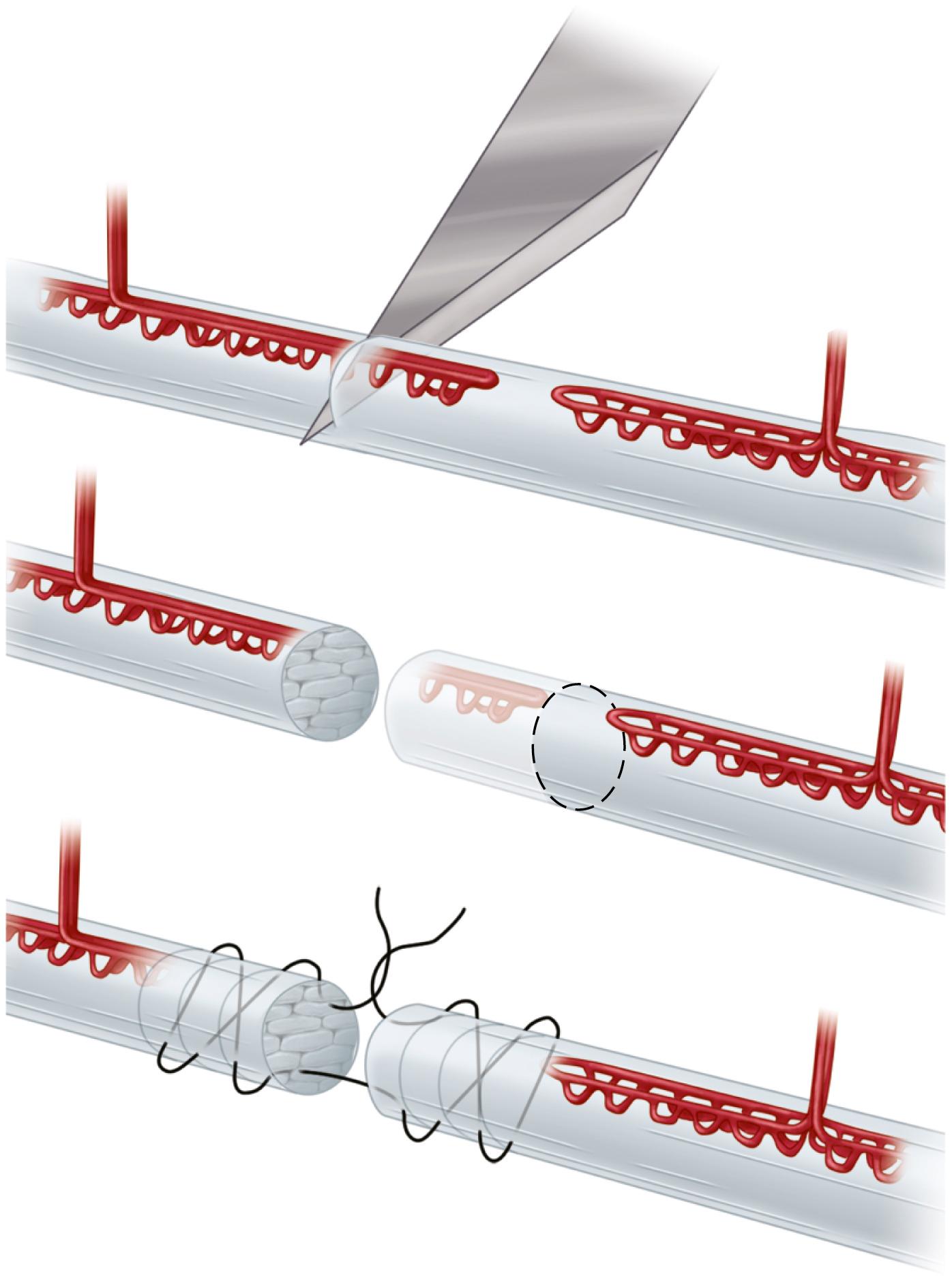 Flexor and Extensor Tendon Injuries - Clinical Tree