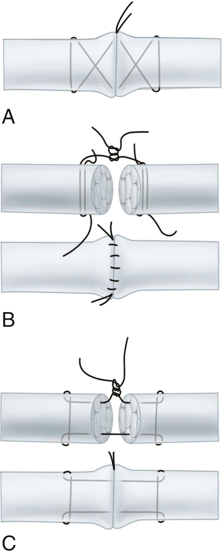 Flexor and Extensor Tendon Injuries - Clinical Tree
