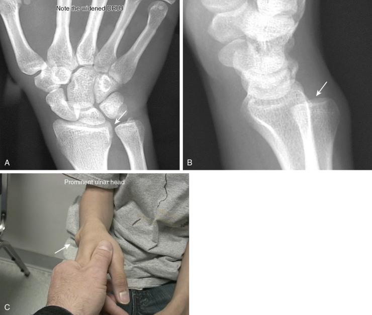 Foveal Tears And Arthroscopy Of The Distal Radioulnar Joint Clinical Tree