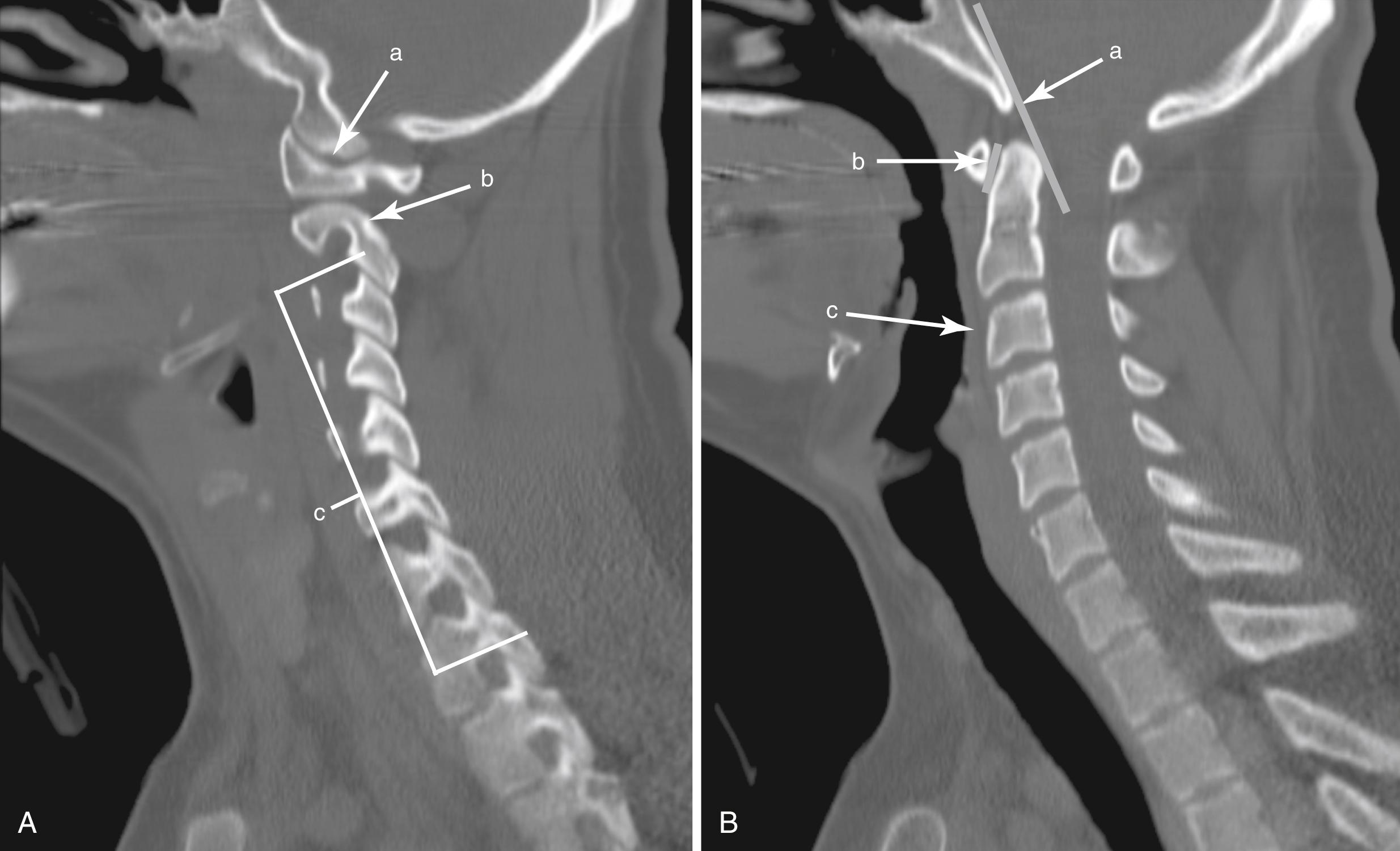 Fractures, Dislocations, and Fracture-Dislocations of the Spine ...