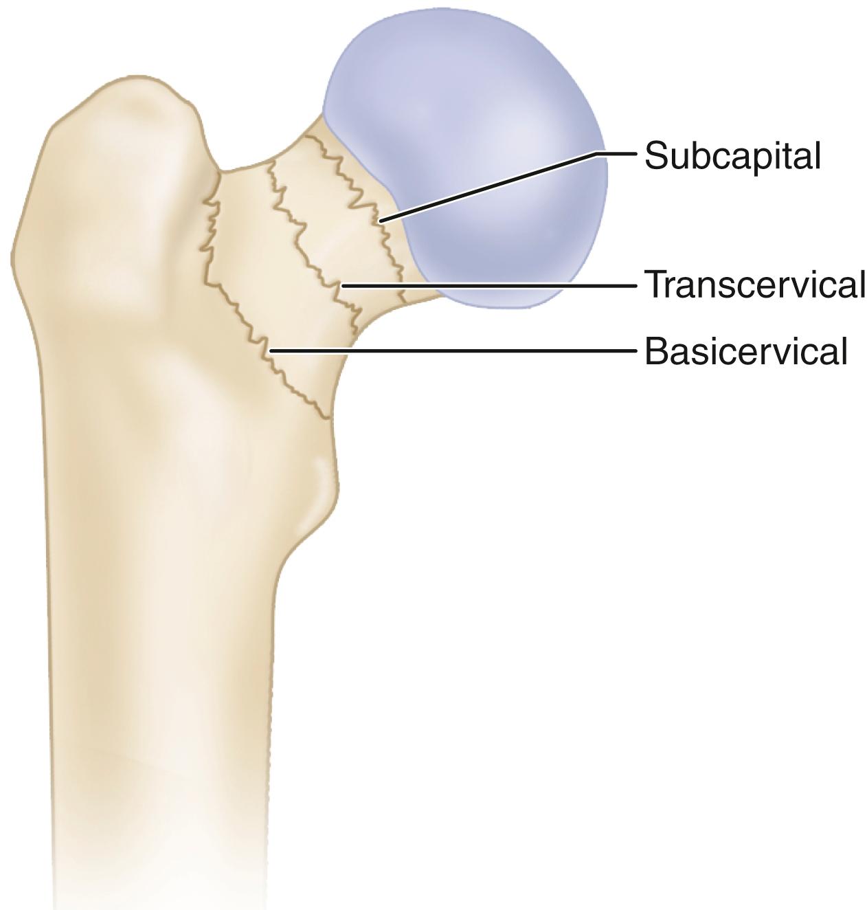 Fractures and Dislocations of the Hip - Clinical Tree
