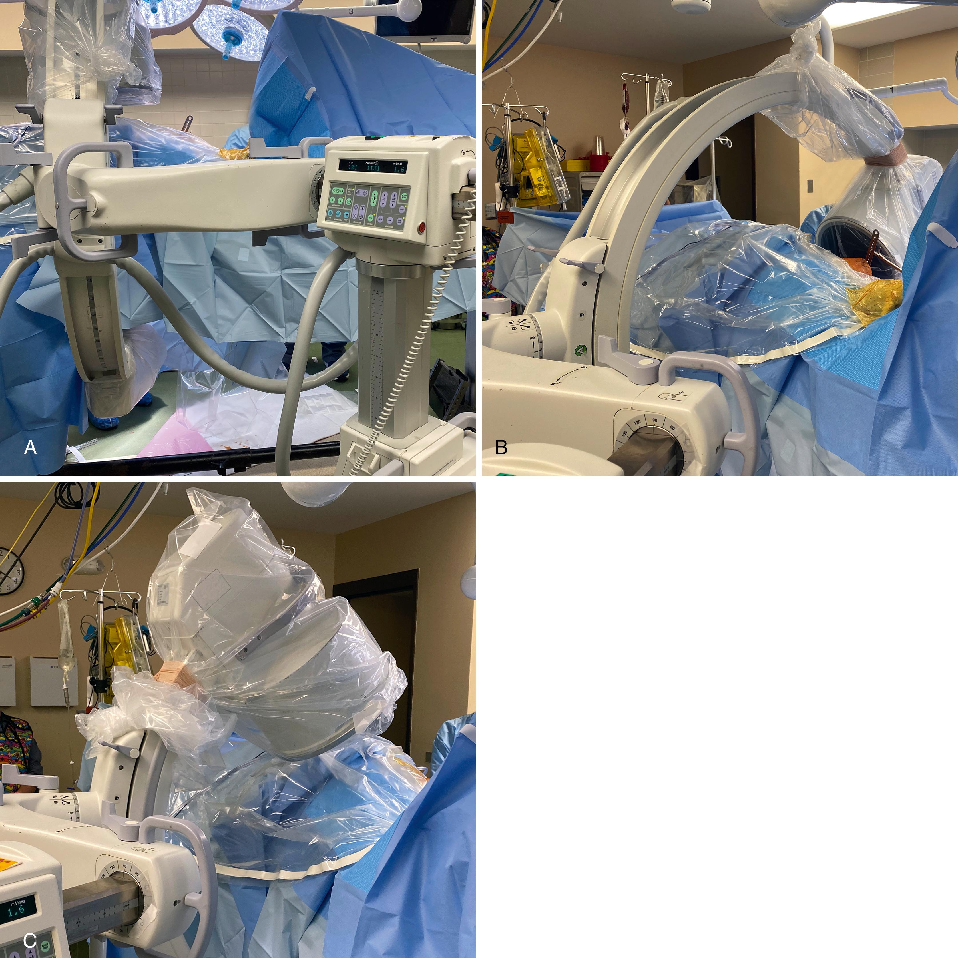 Fractures of the Acetabulum and Pelvis - Clinical Tree