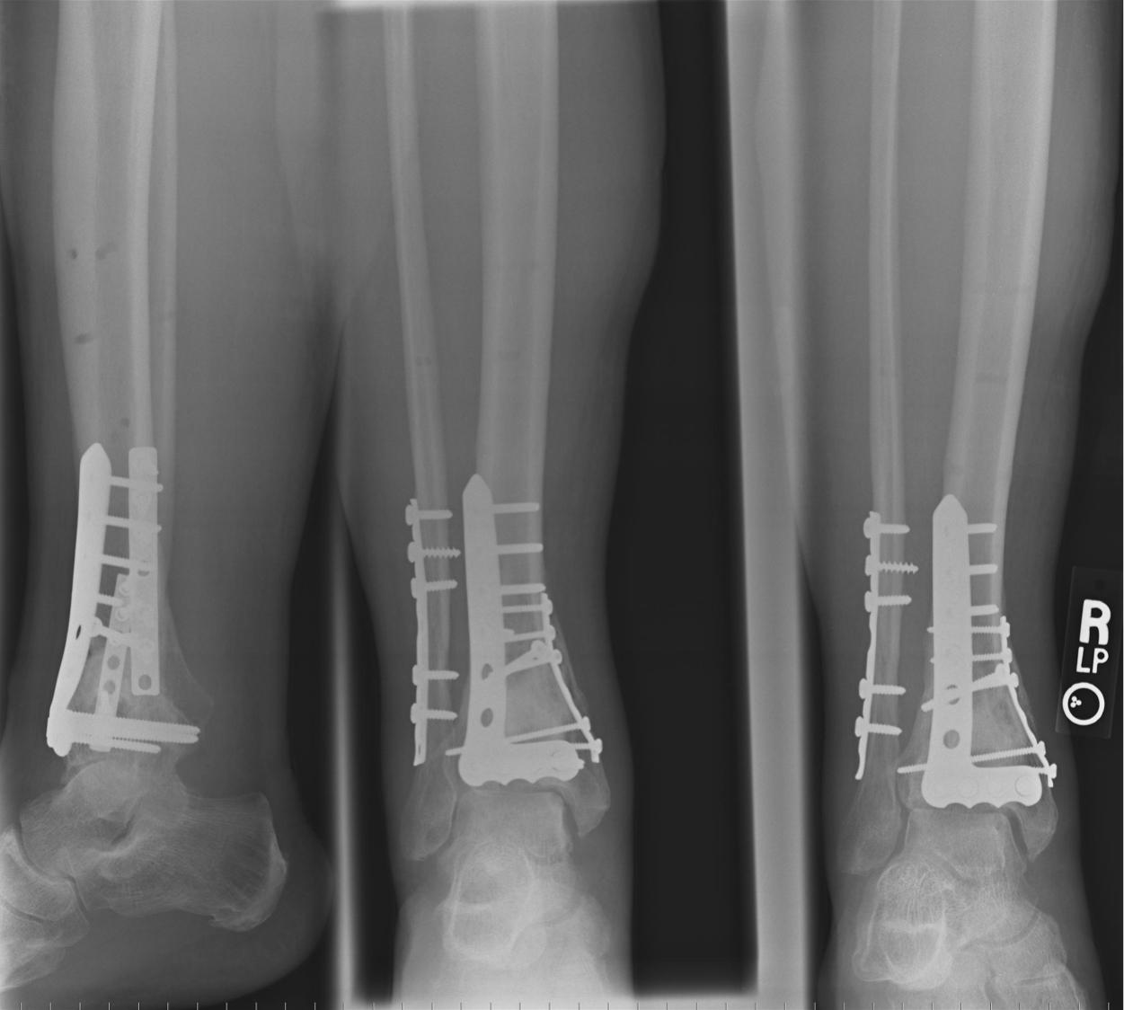 Fractures of the Lower Extremity - Clinical Tree