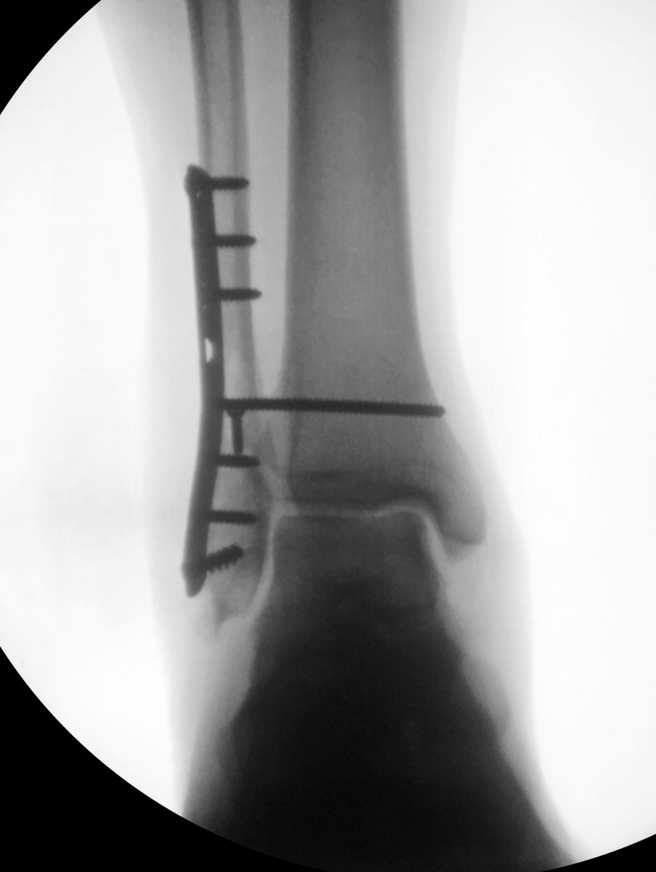 Fractures of the Lower Extremity - Clinical Tree