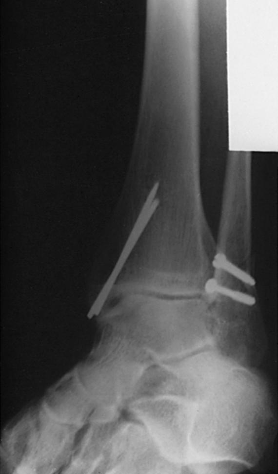 Fractures of the Lower Extremity - Clinical Tree