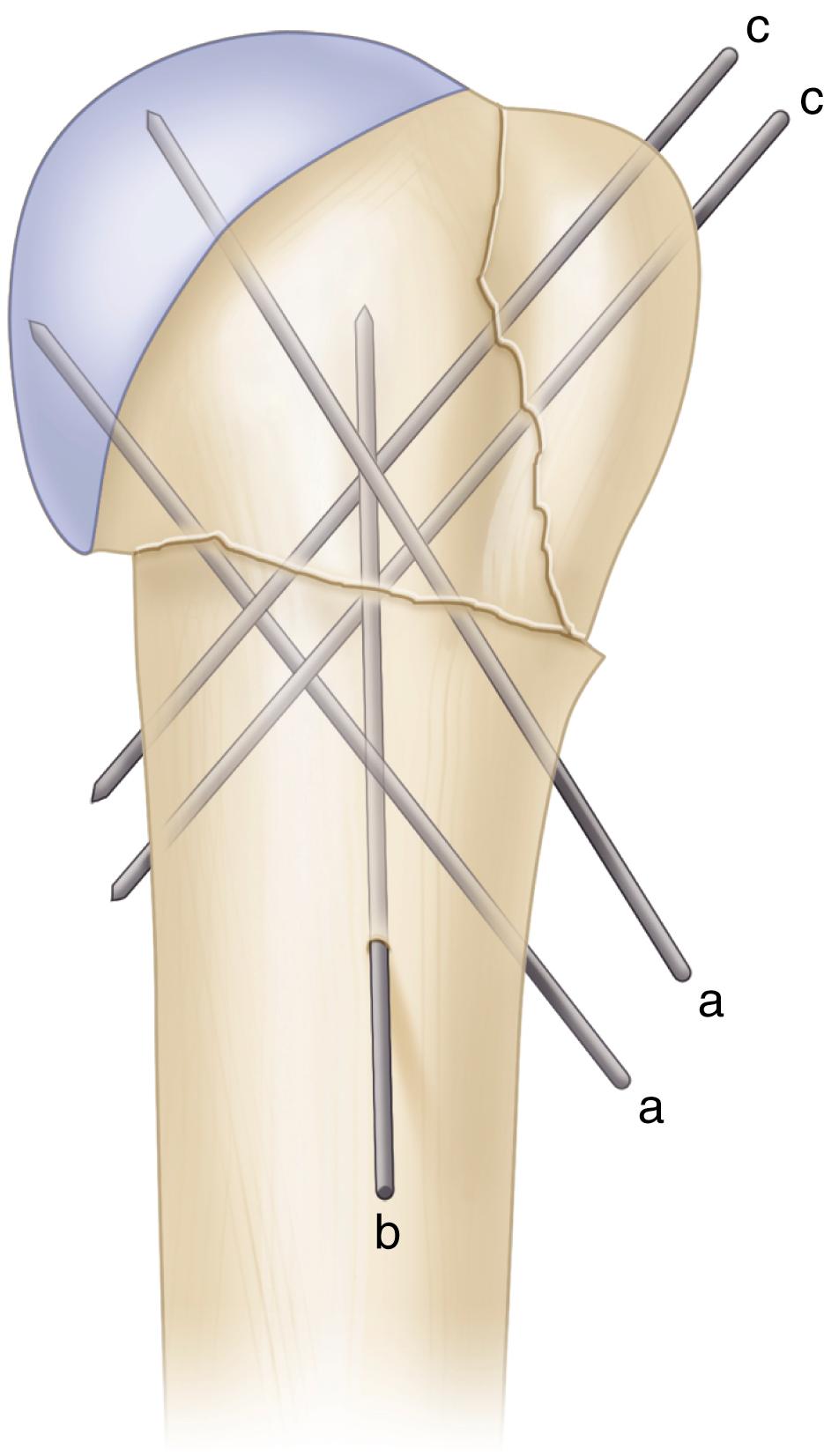 Fractures of the Shoulder, Arm, and Forearm - Clinical Tree