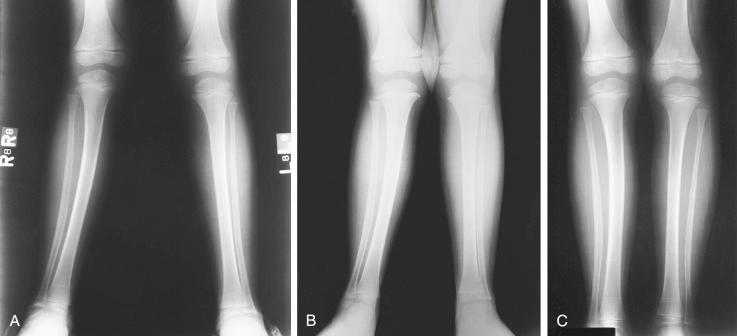 Fractures of the Tibia and Fibula - Clinical Tree
