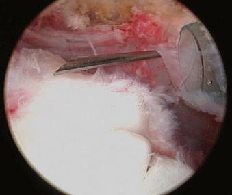 Full-Thickness Rotator Cuff Tears - Clinical Tree