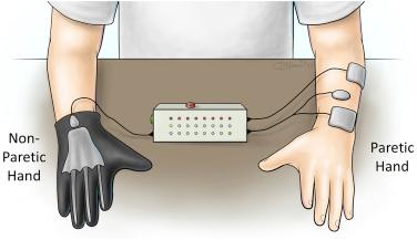 Functional Electrical Stimulation for Return of Function After Stroke ...