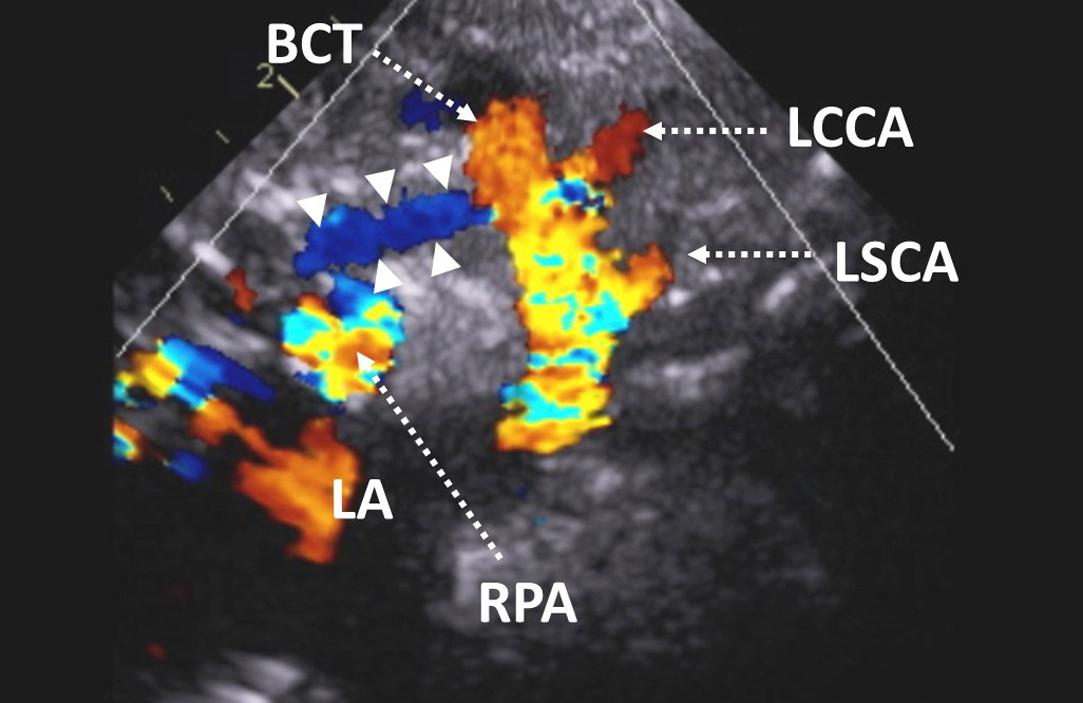 Functionally single ventricle - Clinical Tree