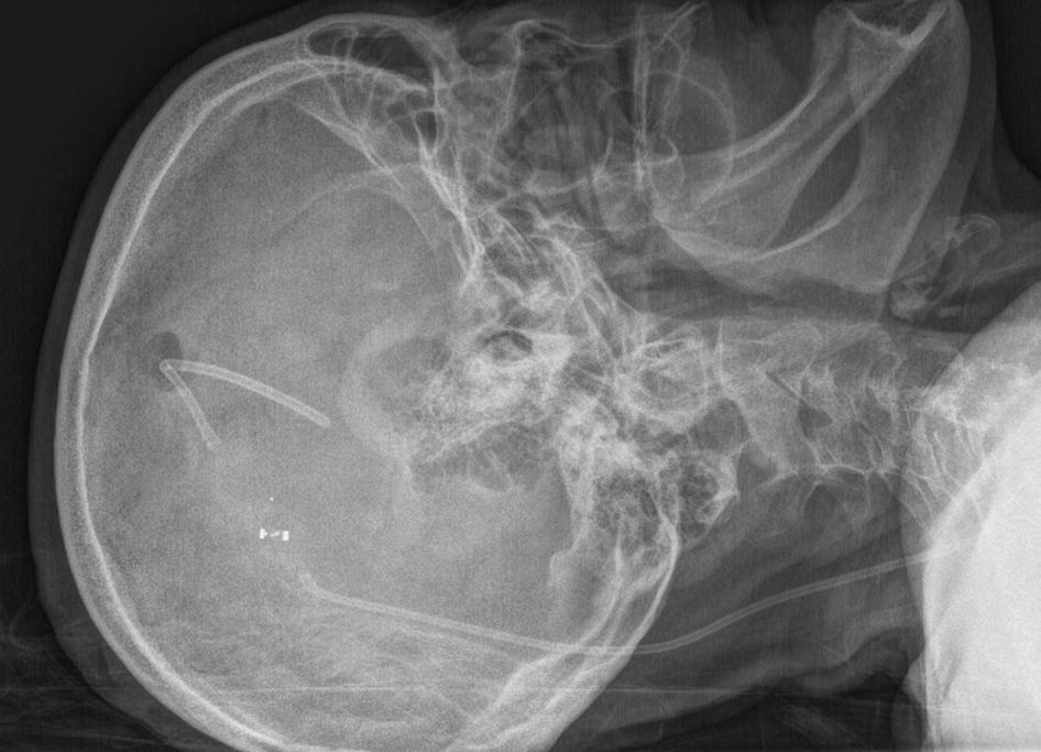 Gait Difficulty And Falls - Clinical Tree