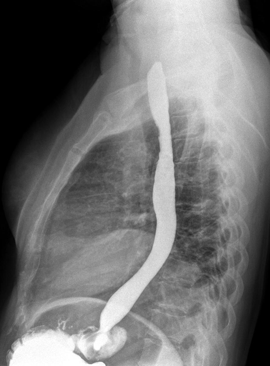 Gastrointestinal Complications of Neuromuscular Disorders - Clinical Tree
