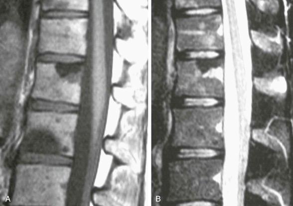 General Principles of MRI of the Bone Marrow - Clinical Tree