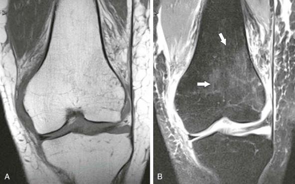 General Principles of MRI of the Bone Marrow - Clinical Tree