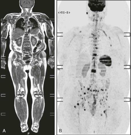 General Principles of MRI of the Bone Marrow - Clinical Tree