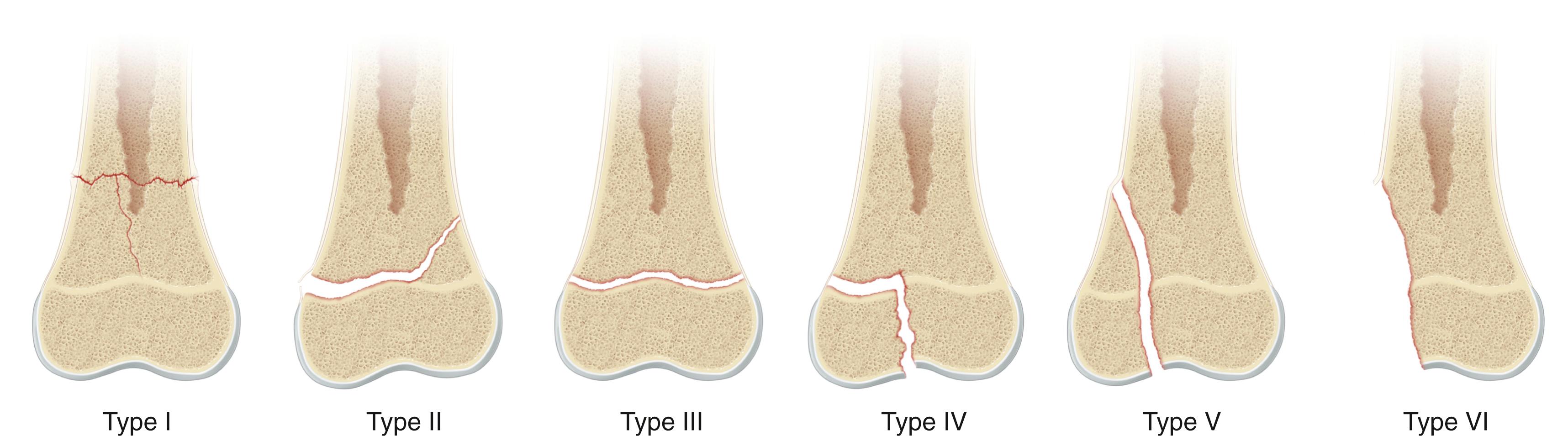 General Principles of Managing Orthopaedic Injuries - Clinical Tree