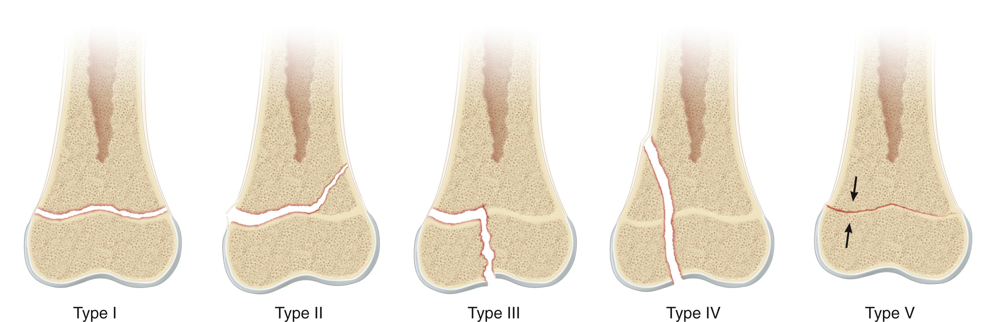 General Principles of Managing Orthopaedic Injuries - Clinical Tree