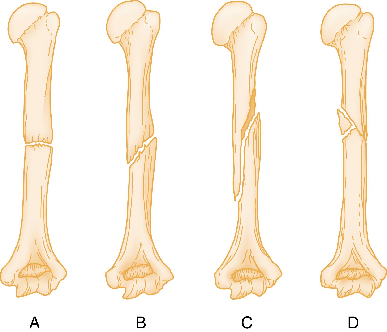 General Principles of Orthopedic Injuries - Clinical Tree