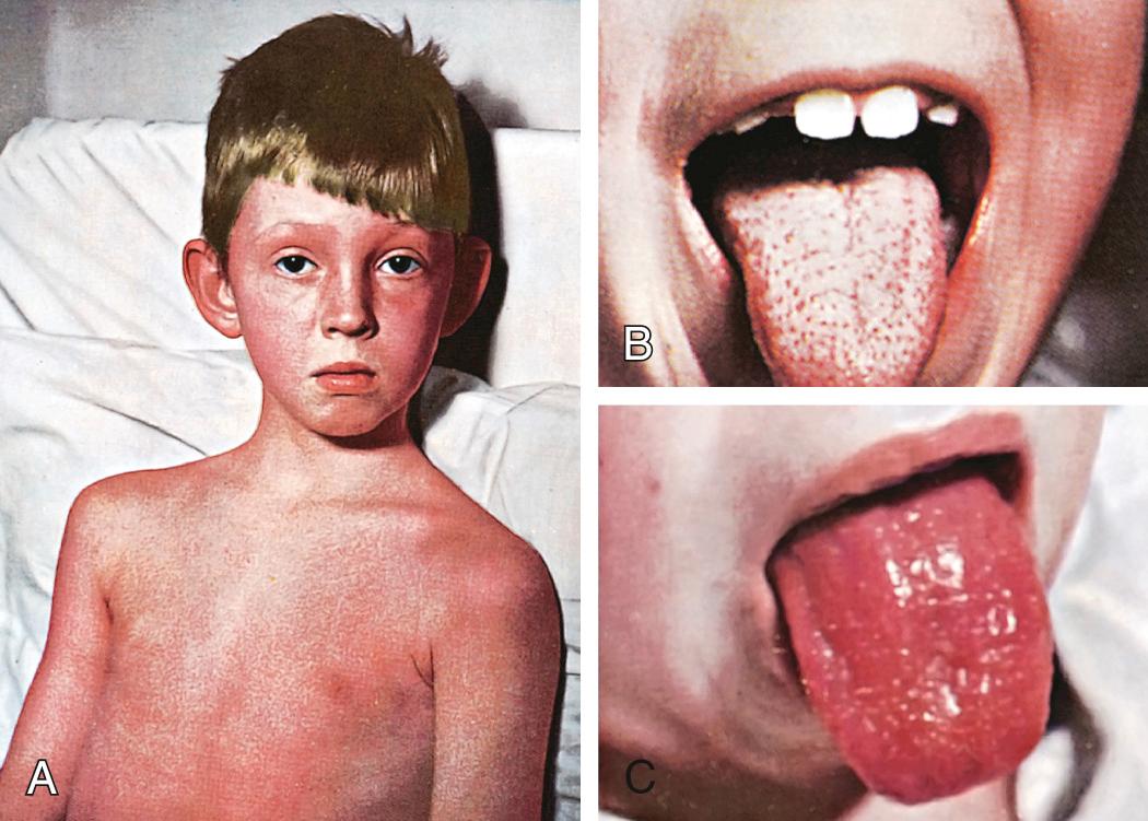 Group A Streptococcus - Clinical Tree