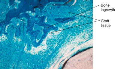 Hamstring Anterior Cruciate Ligament Reconstruction with INTRAFIX and ...