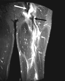 Hamstring Injuries - Clinical Tree