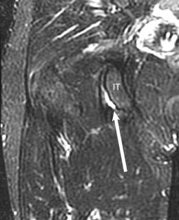 Hamstring Injuries - Clinical Tree