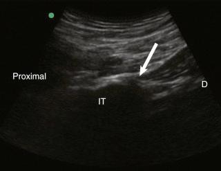 Hamstring Injuries - Clinical Tree