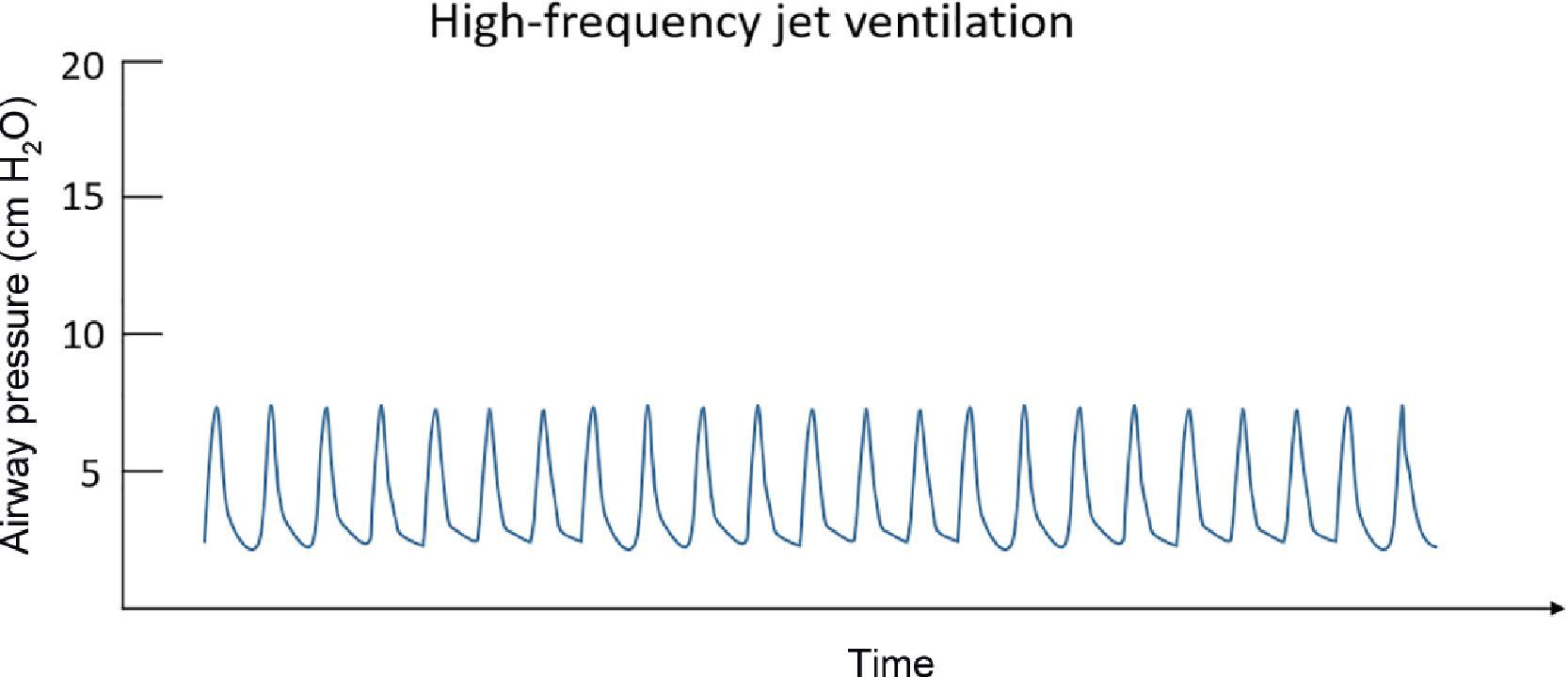 High-Frequency Ventilation: Applications in Thoracic Anesthesia ...