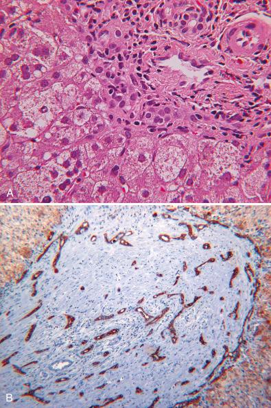 Histologic Patterns of Metabolic Liver Diseases - Clinical Tree