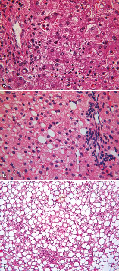 Histologic Patterns of Metabolic Liver Diseases - Clinical Tree