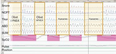 Home Sleep Testing - Clinical Tree