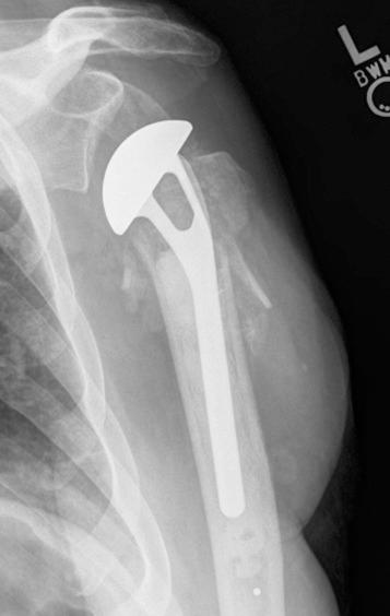 Humeral prosthetic positioning - Clinical Tree