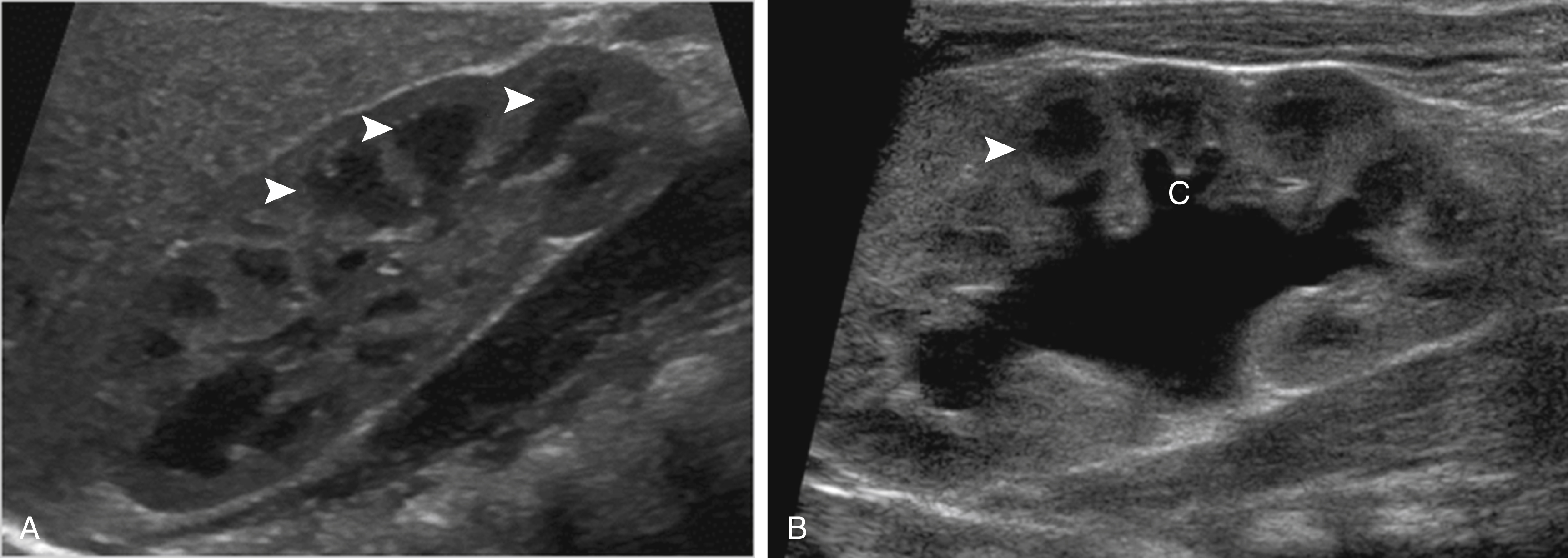 Imaging Approach to Urinary Tract Dilation - Clinical Tree