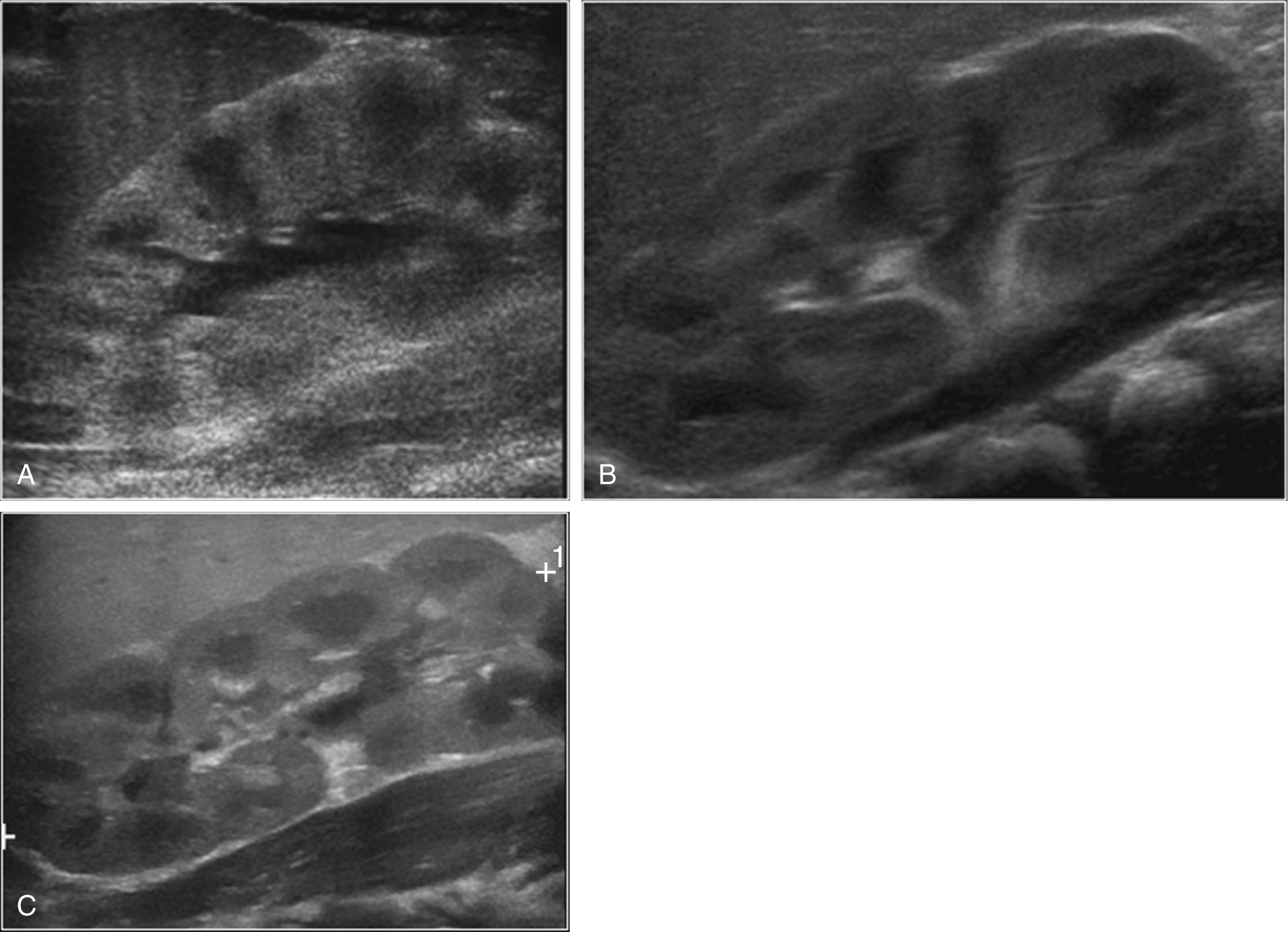 Imaging Approach to Urinary Tract Dilation - Clinical Tree