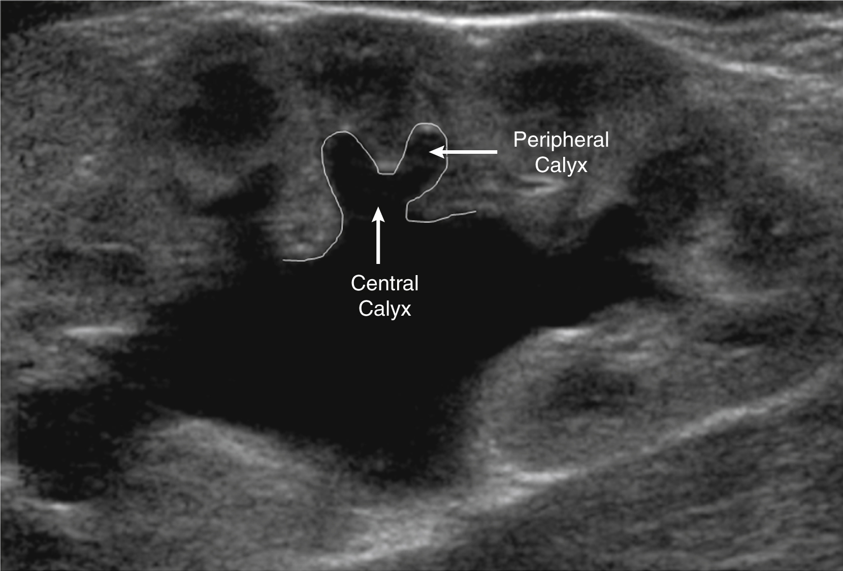 Imaging Approach to Urinary Tract Dilation - Clinical Tree