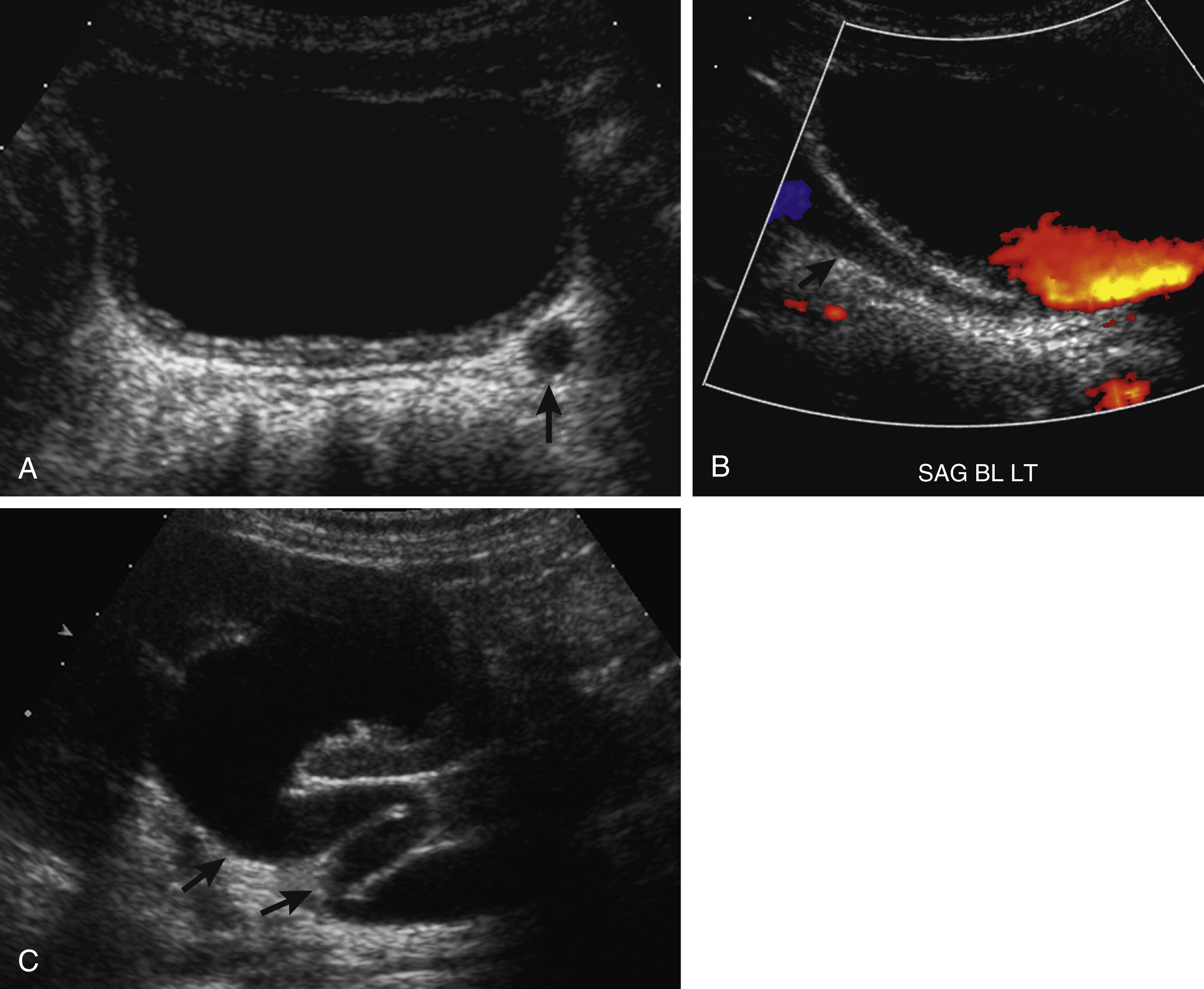 Imaging Approach to Urinary Tract Dilation - Clinical Tree