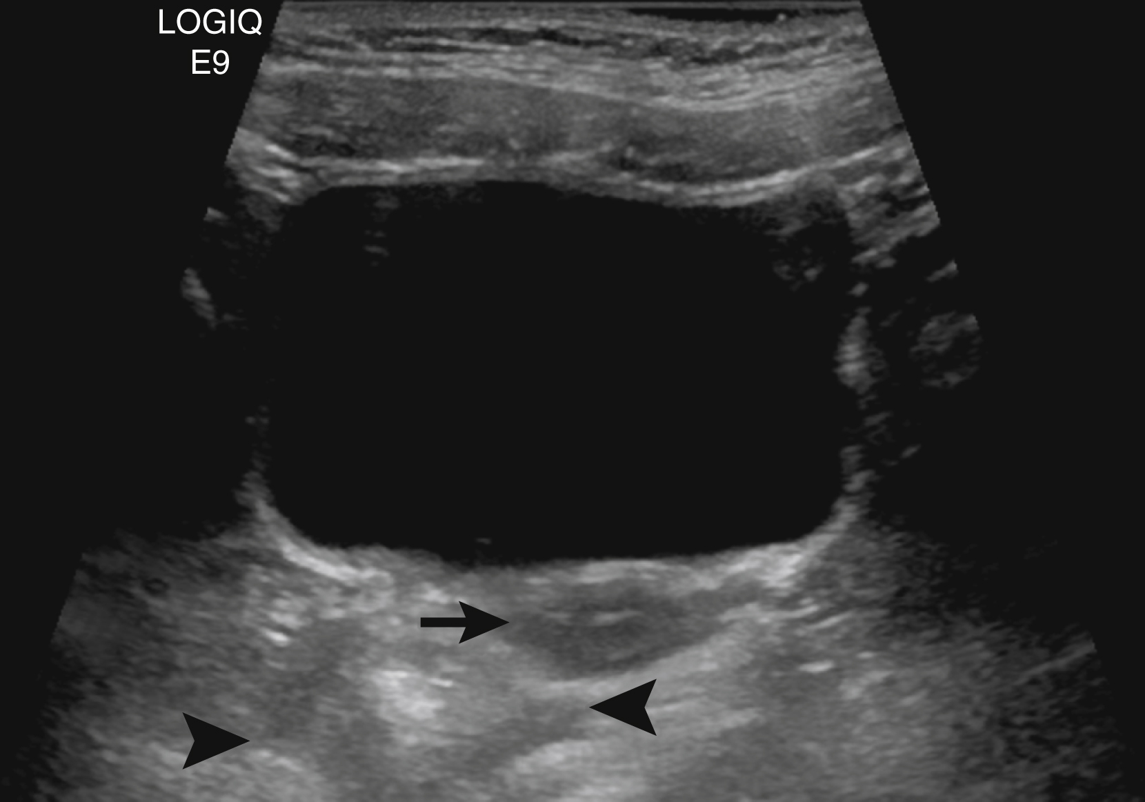 Imaging Approach to Urinary Tract Dilation - Clinical Tree