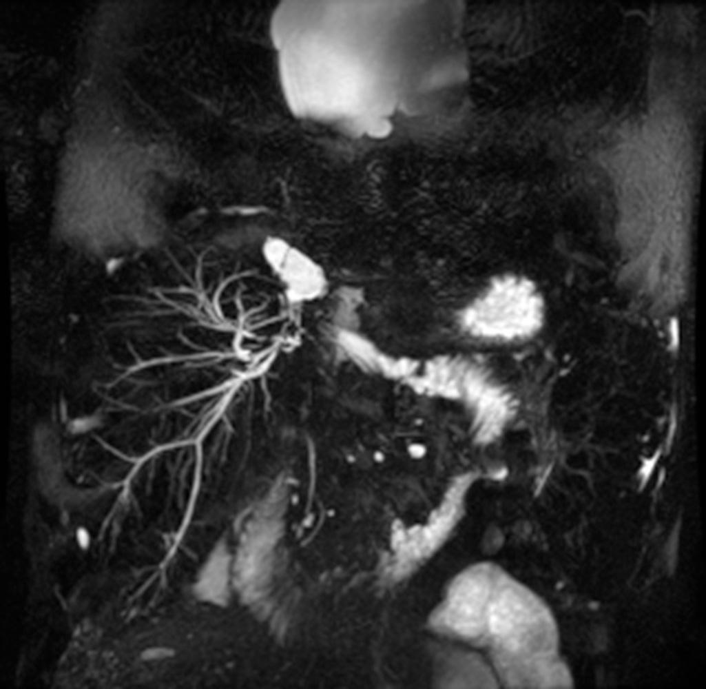 Imaging and Radiologic Intervention in the Biliary Tract - Clinical Tree
