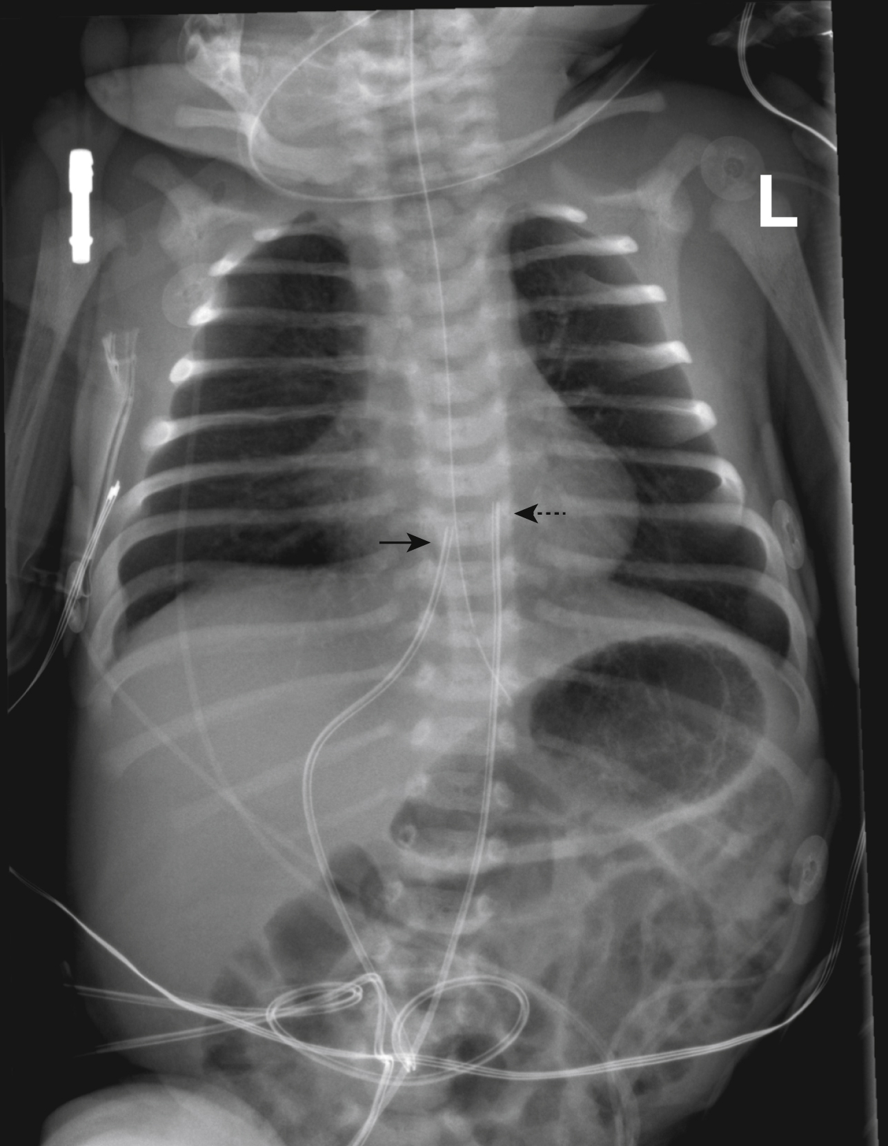 Imaging of the Neonate: Preterm Infant - Clinical Tree
