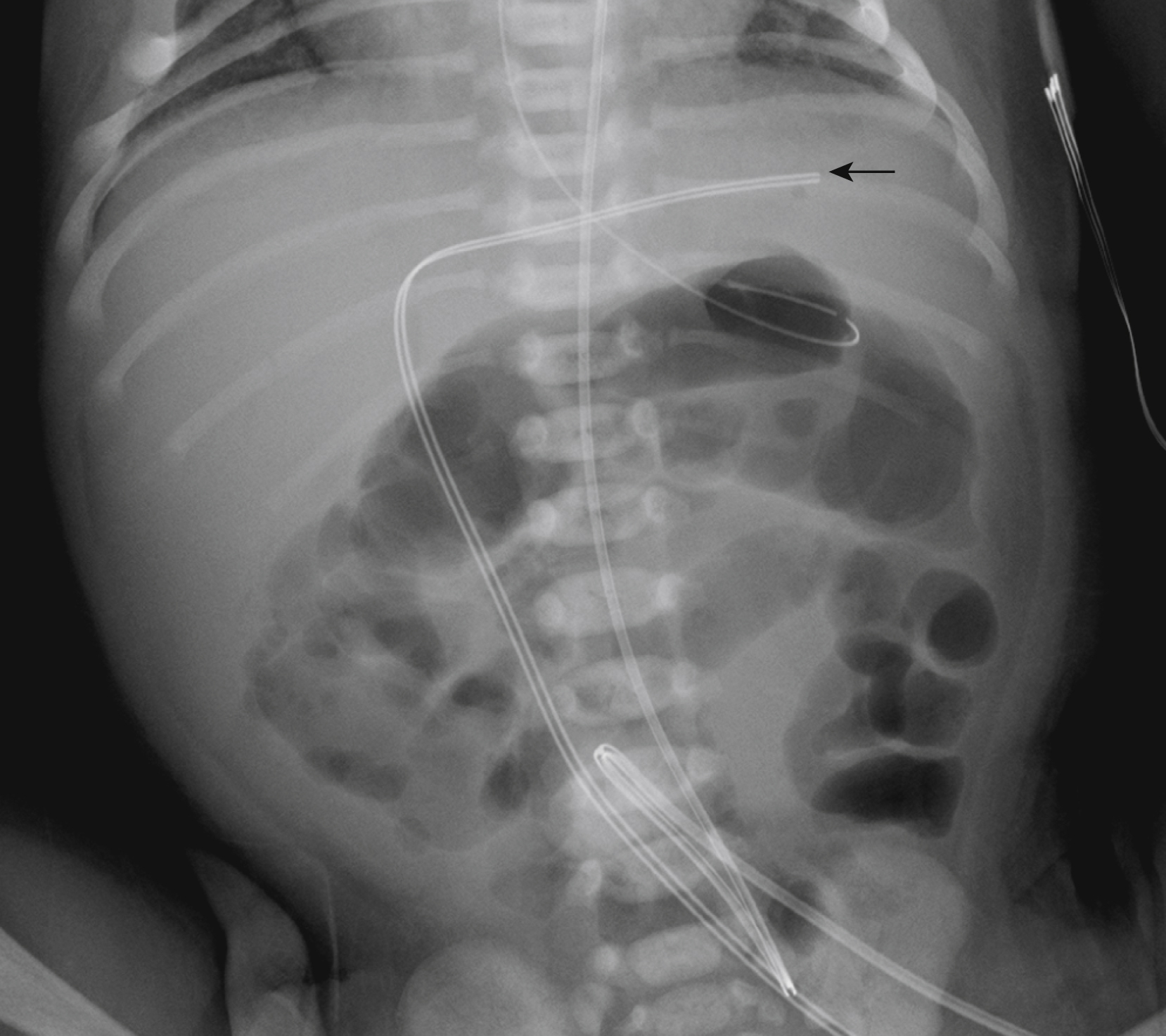Imaging of the Neonate: Preterm Infant - Clinical Tree