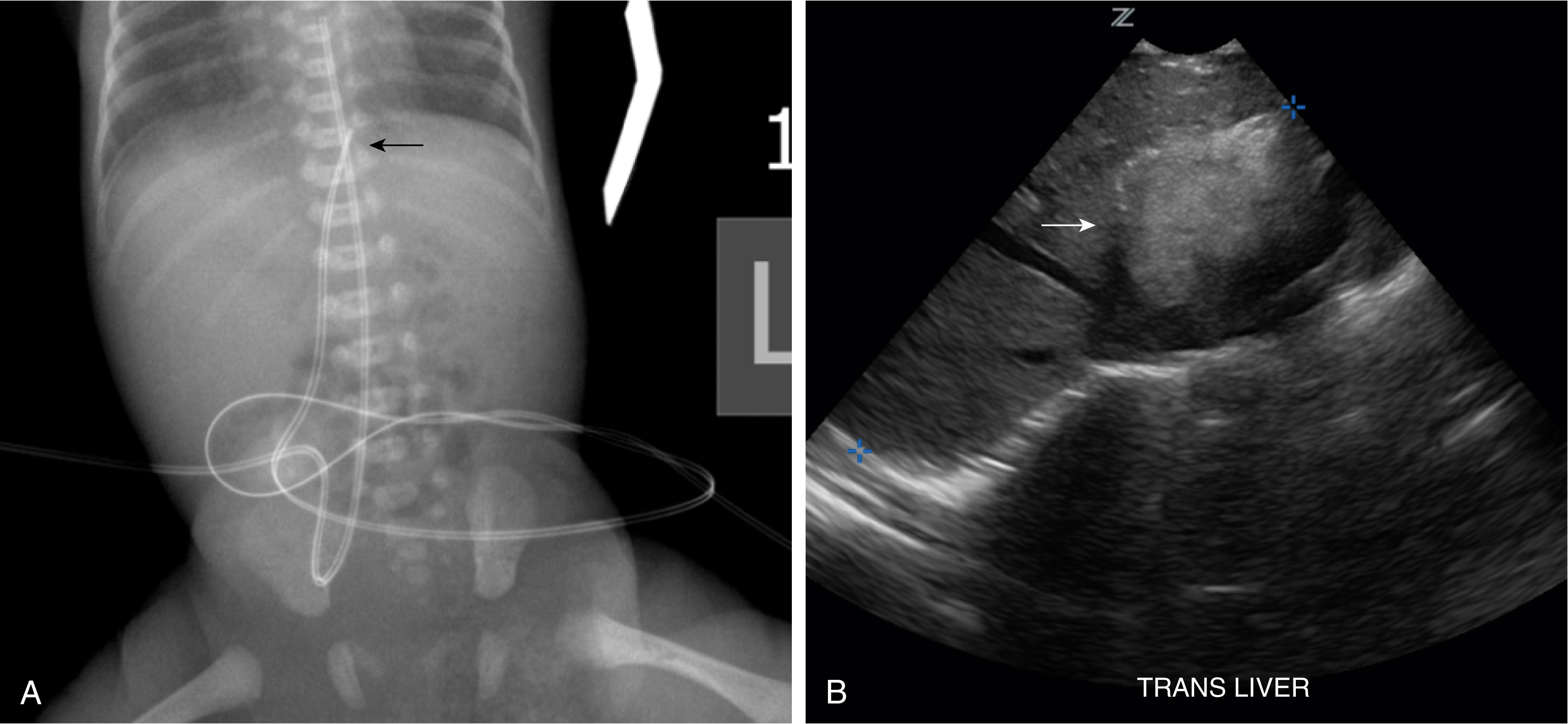 Imaging of the Neonate: Preterm Infant - Clinical Tree
