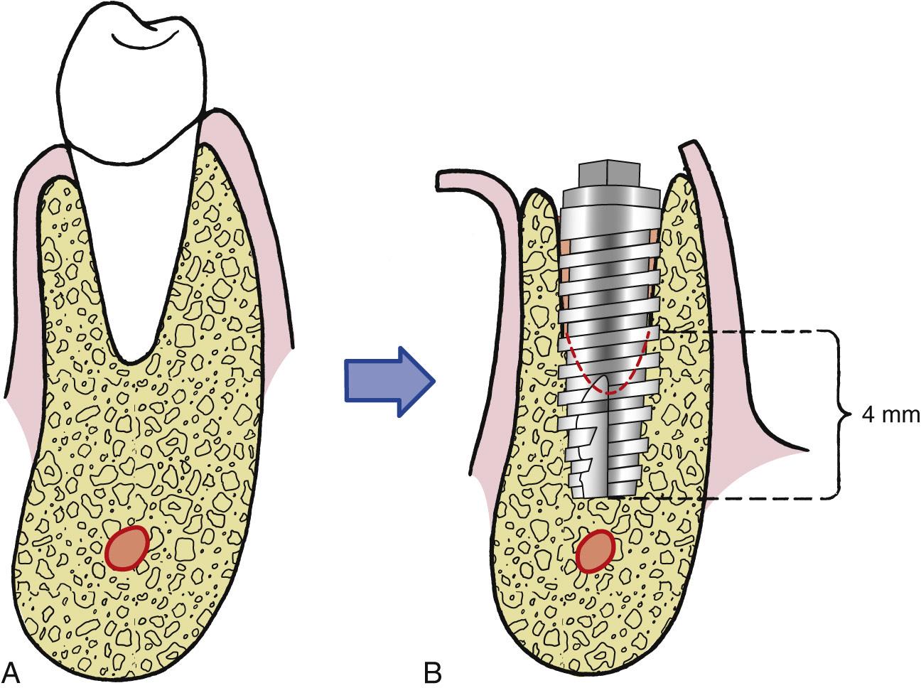 Implant Treatment: Advanced Concepts and Complex Cases - Clinical Tree