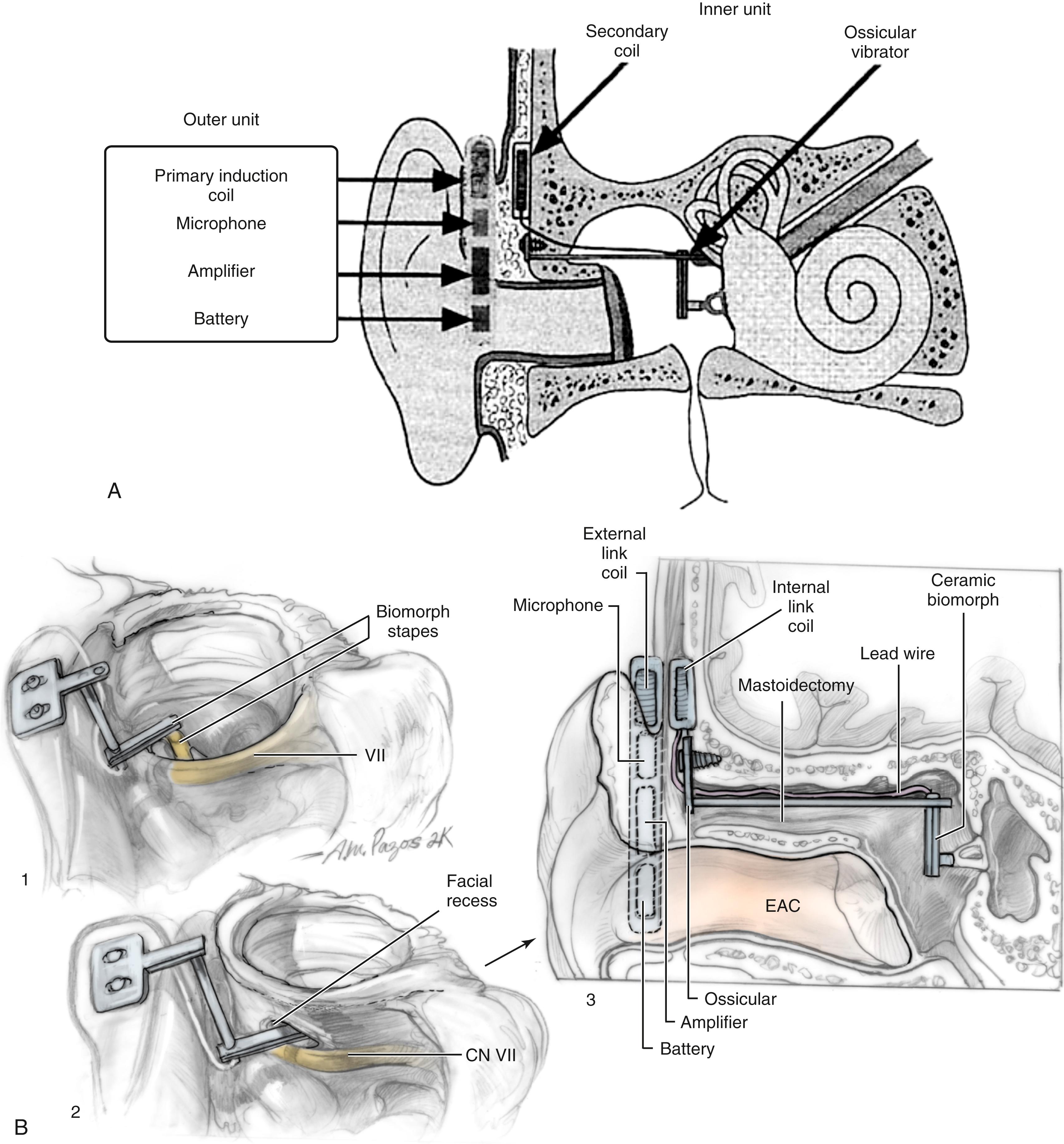 Implantable Hearing Devices - Clinical Tree Implantable Hearing Devices - Clinical Tree