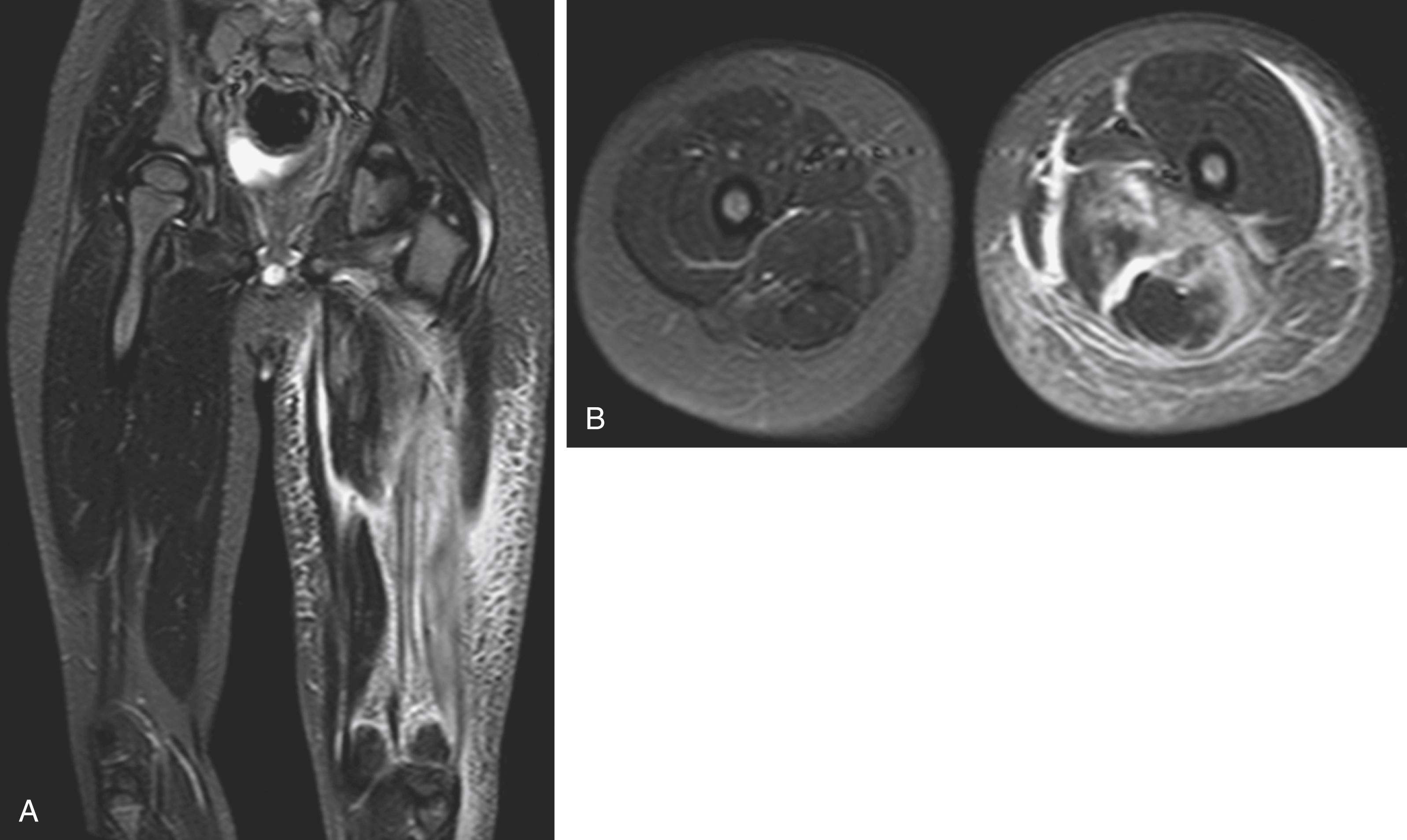 Infections of the Musculoskeletal System - Clinical Tree